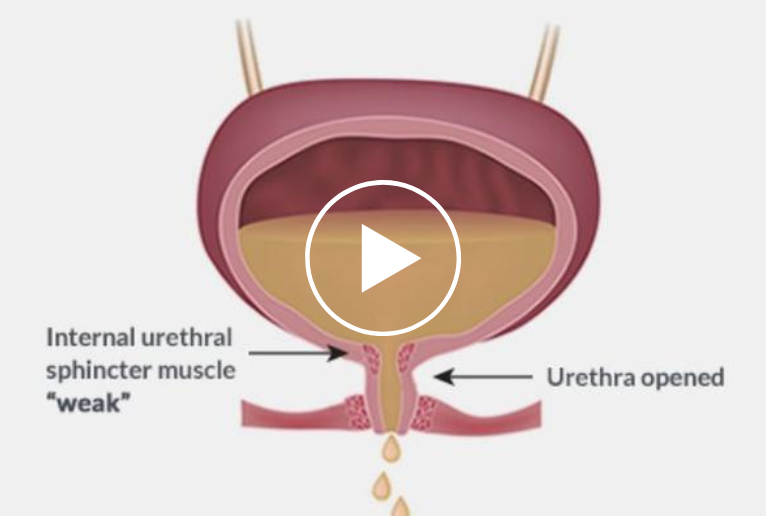 Bulkamid | CAMC Health System