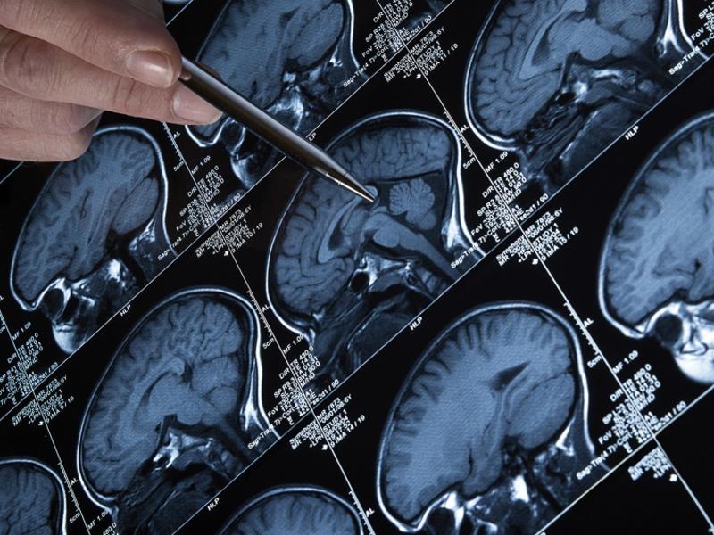 Neurology | Neurosciences | CAMC | CAMC Health System